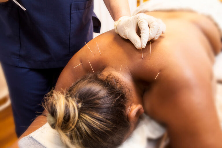 Dry Needling in Surrey | Renew Physiotherapy